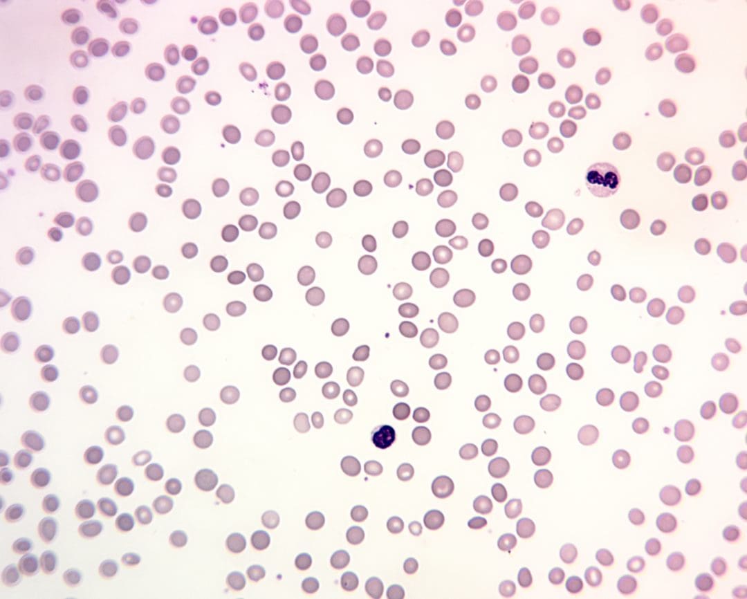 Hereditary Spherocytosis | My Hematology