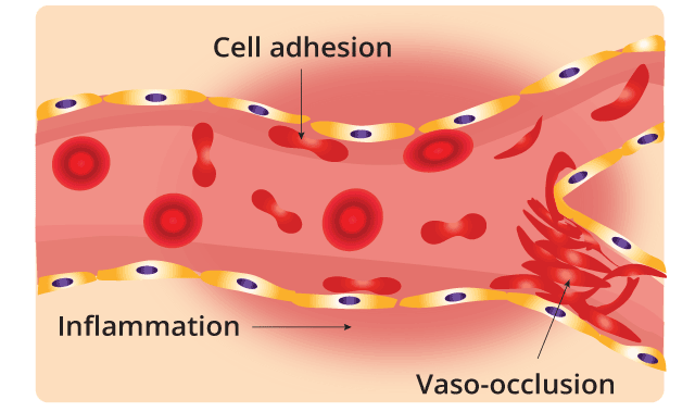 Sickle Cell Anemia: Vaso-Occlusive Crisis, Symptoms & Treatment