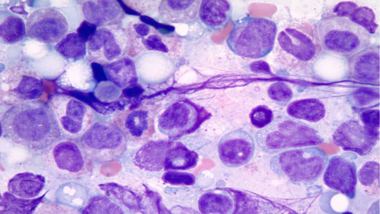 Myelodysplastic Syndrome or MDS: Types, Symptoms & Diagnosis