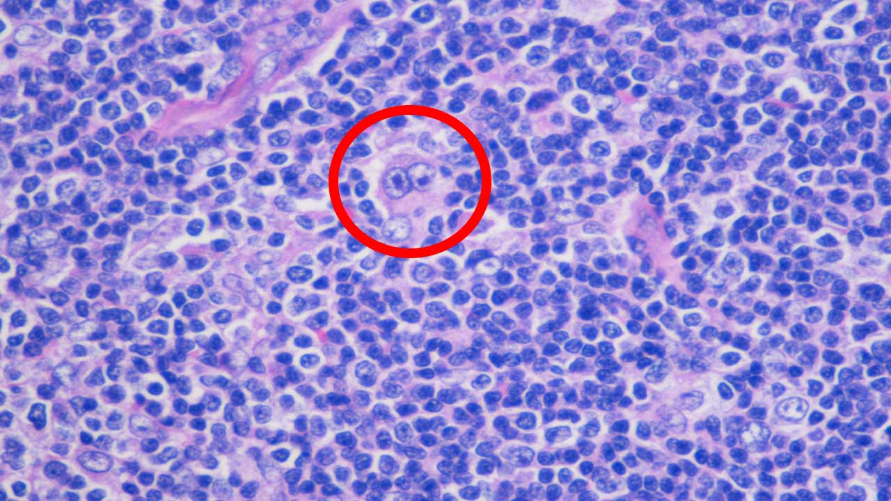 Hodgkin Lymphoma or Hodgkin's disease & Reed-Sternberg Cells