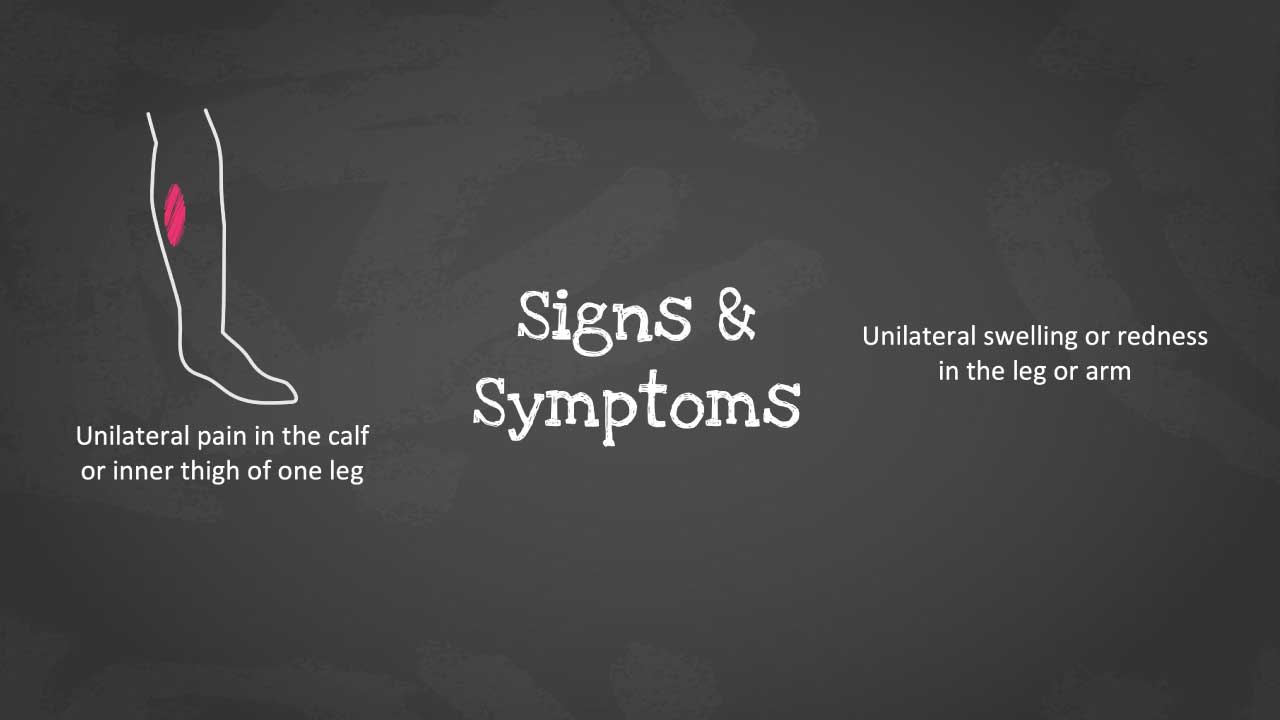 Venous Thrombosis (VTE) | My Hematology