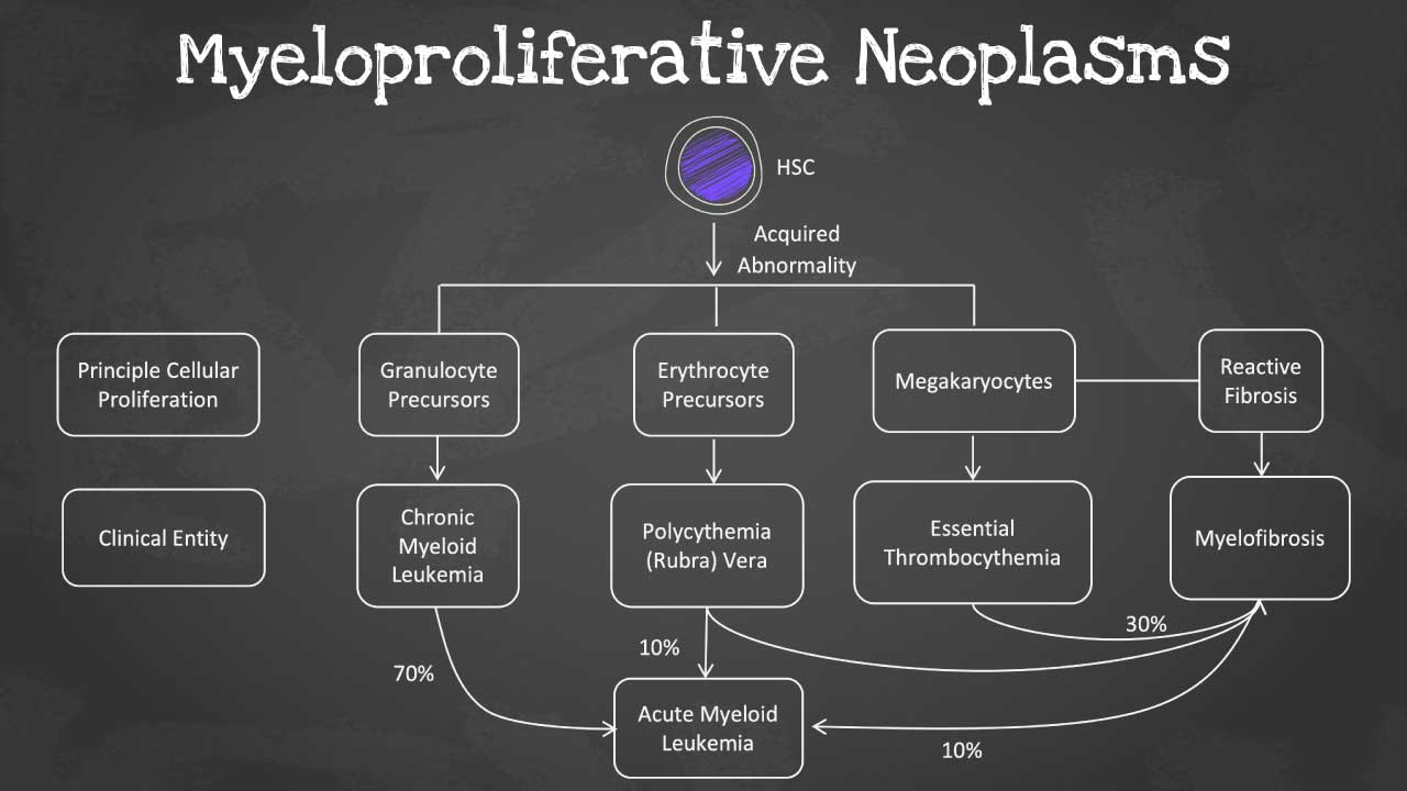 Myeloproliferative Neoplasms (MPN): Symptoms, Types & Diagnosis