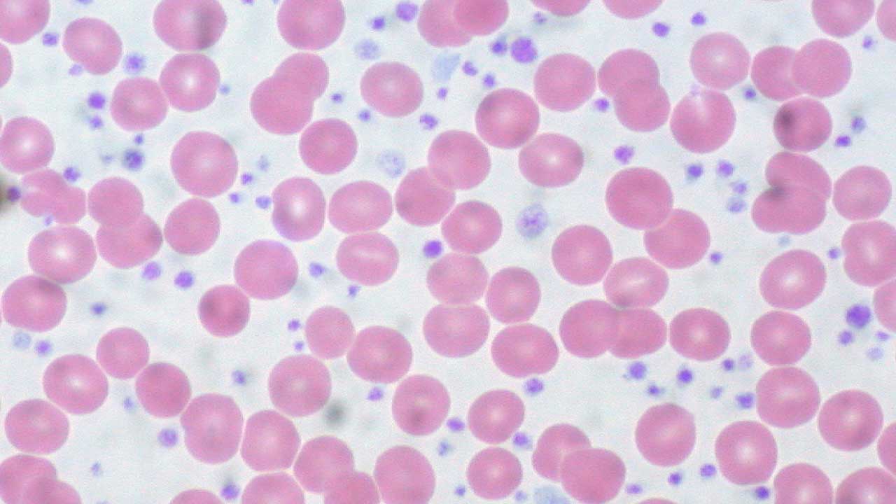Essential Thrombocythemia (ET): Causes, Symptoms & Diagnosis