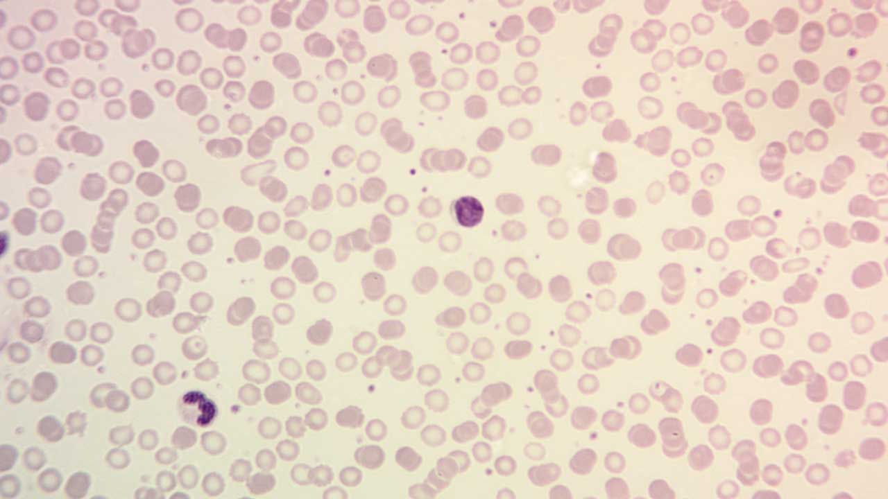 Hematopathology: A Diagnostic Detective | My Hematology