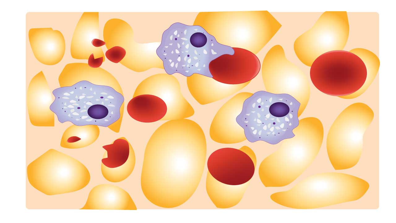 Hemolytic Anemia: Classifications, Symptoms & Diagnosis