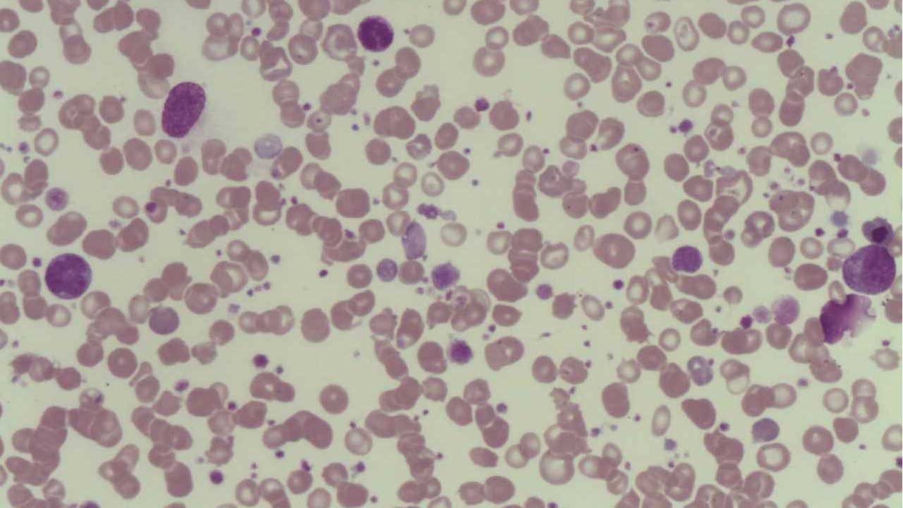 Platelet Function Disorders: Causes, Symptoms & Diagnosis
