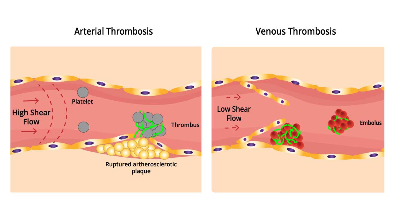 Thrombosis: Causes, Symptoms, Diagnosis & Treatment
