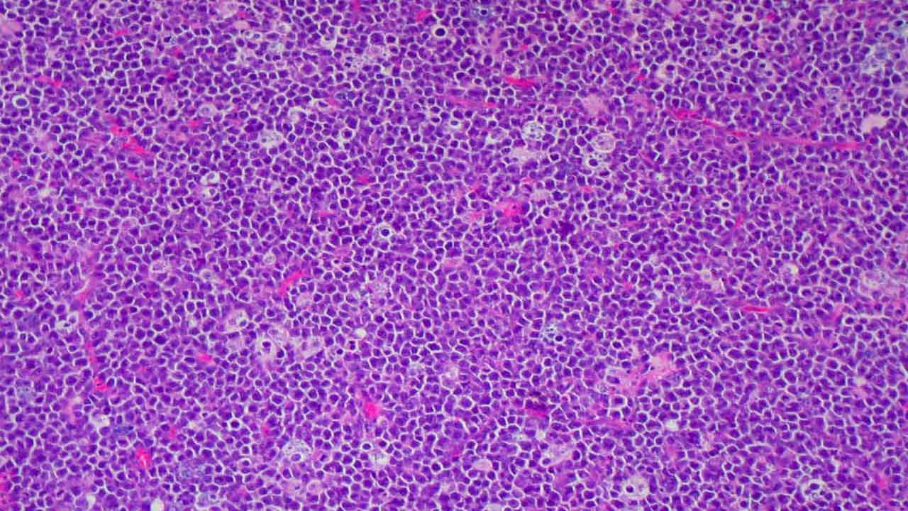 Burkitt Lymphoma: Causes, Symptoms, Investigations & Treatment