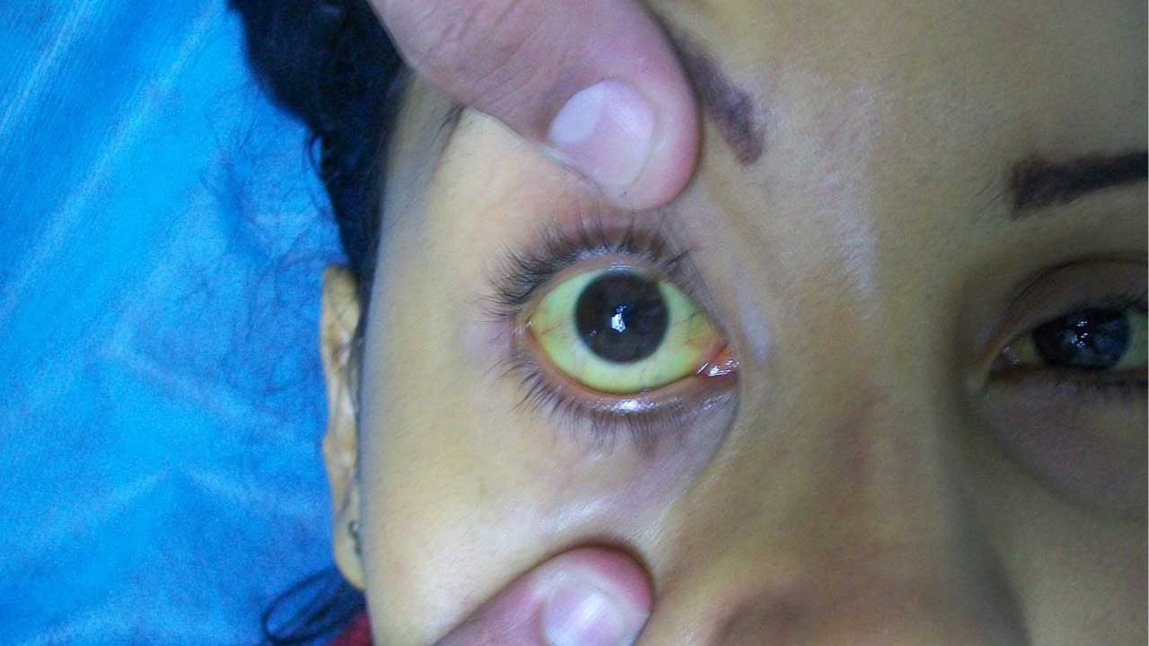 Jaundice: Types, Causes, Symptoms, Treatment & Complications