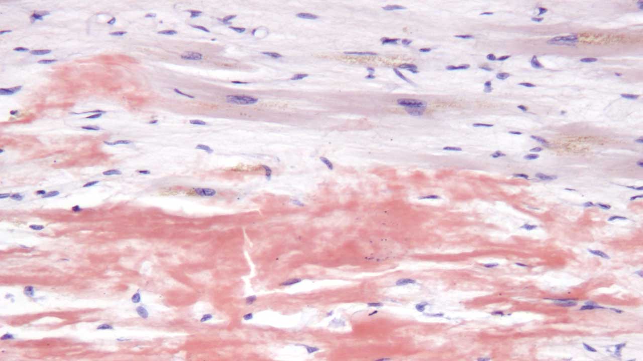 AL (Primary) Amyloidosis: Causes, Symptoms & Treatment