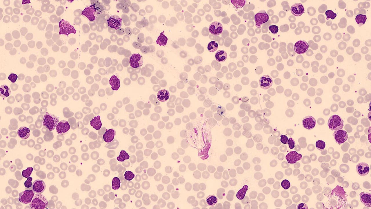 Neutrophilia or High Neutrophils and Absolute Neutrophilia