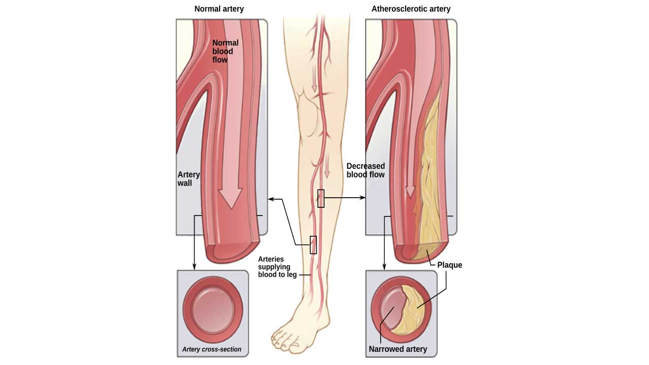 Peripheral Artery Disease: Causes, Symptoms and Treatment