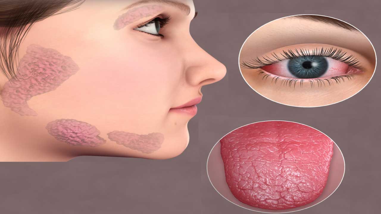 Sjögren's Syndrome: Symptoms, Causes, Diagnosis & Treatment