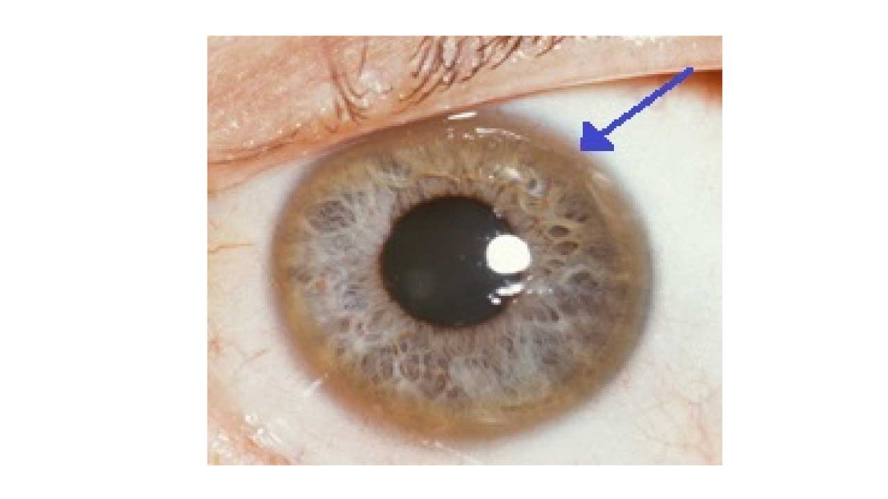 Wilson's Disease: Causes, Symptoms, Investigations & Treatment