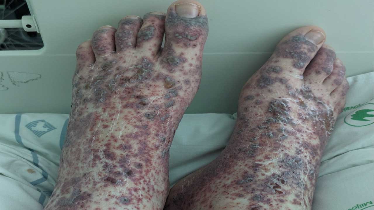 Henoch-Schönlein Purpura (HSP): Causes, Symptoms & Treatment