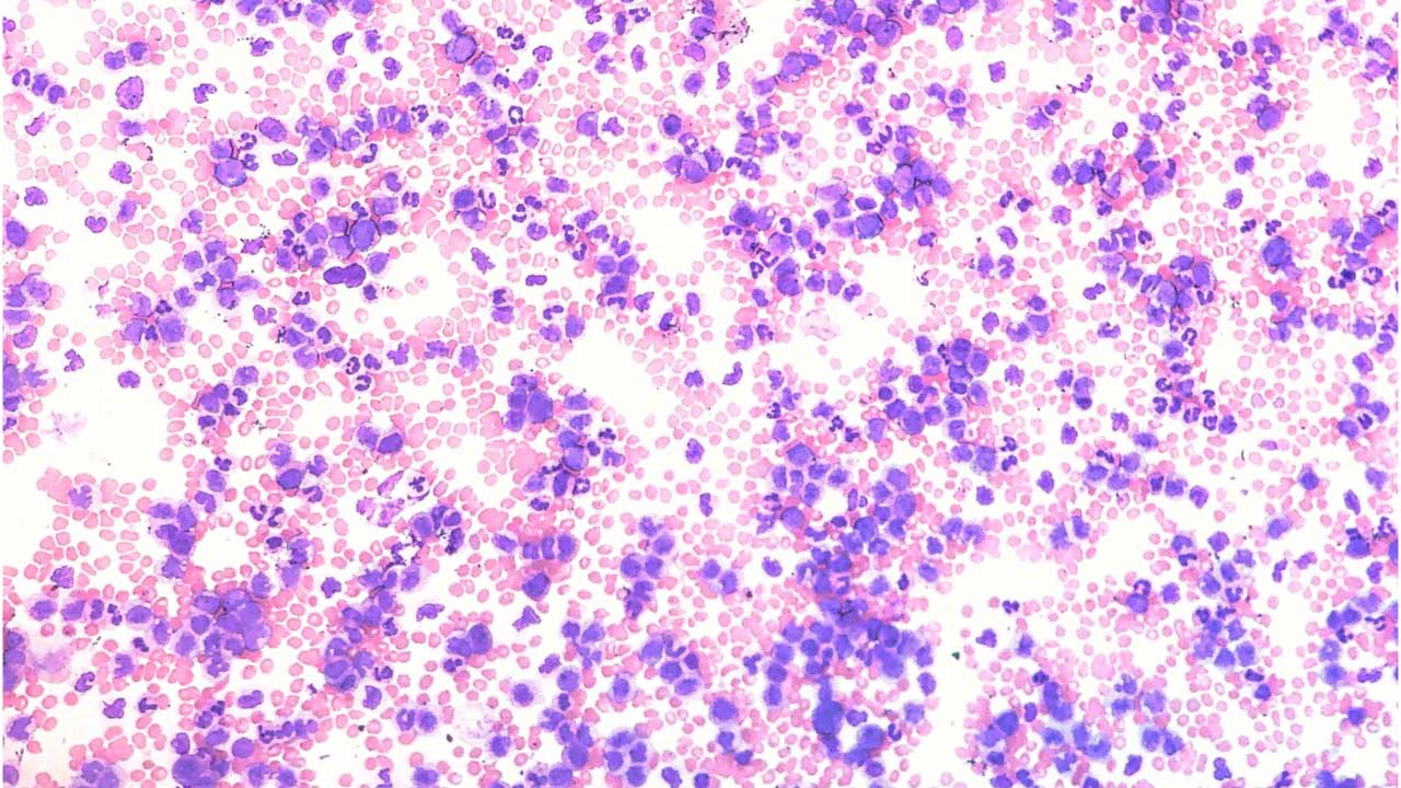 Understanding Monocytosis (High Monocytes): Causes and Symptoms