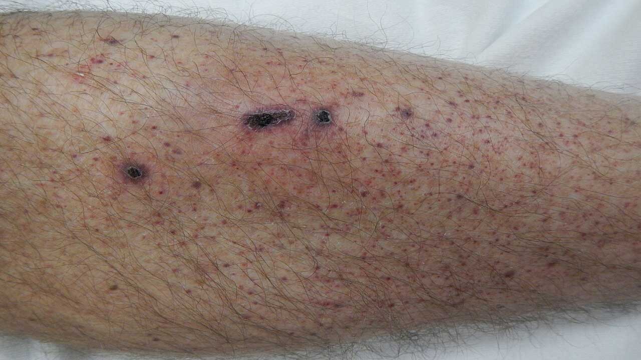 Understanding Petechiae: Causes, Symptoms & Investigations