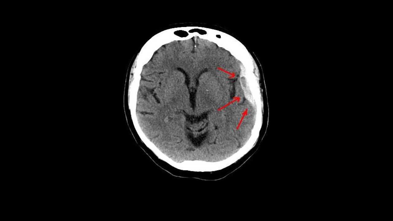 Understanding Hematoma: Causes, Types, Symptoms & Treatment