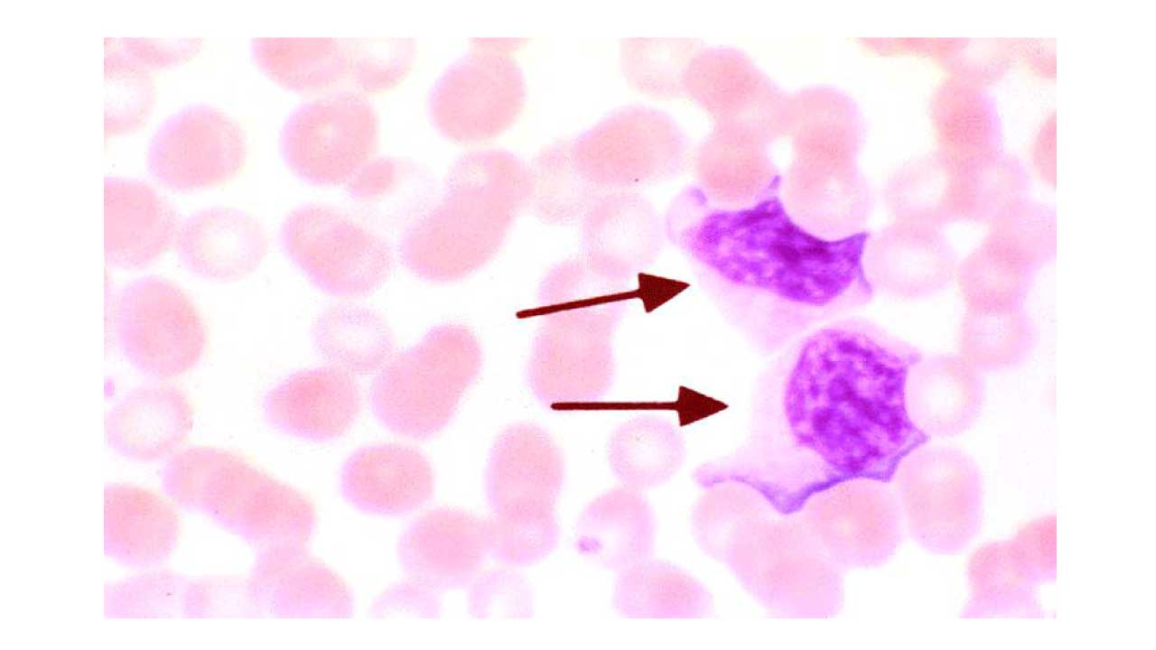 Causes of Atypical Lymphocytes (Reactive Lymphocytes)