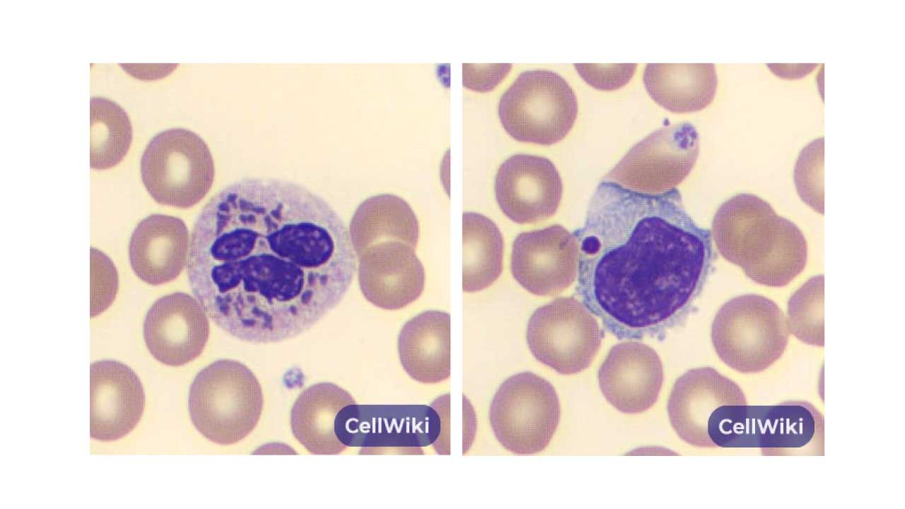 Chediak-Higashi Syndrome: Causes, Symptoms, Diagnosis & Treatment